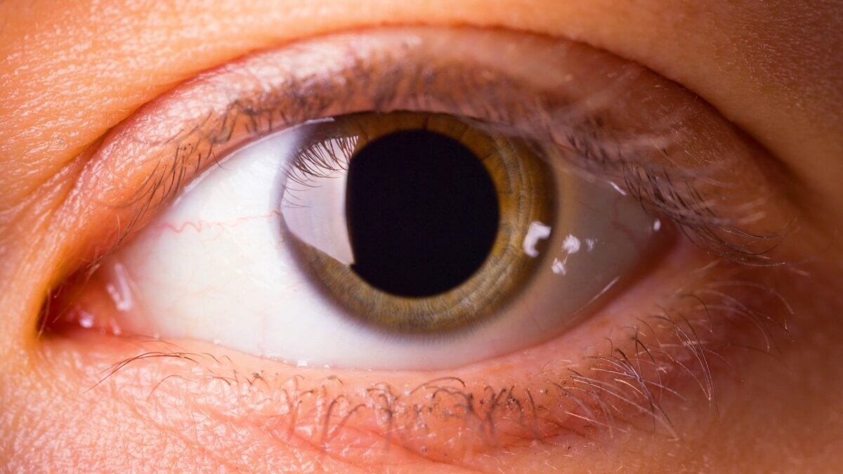 Eyes Before And After Weed